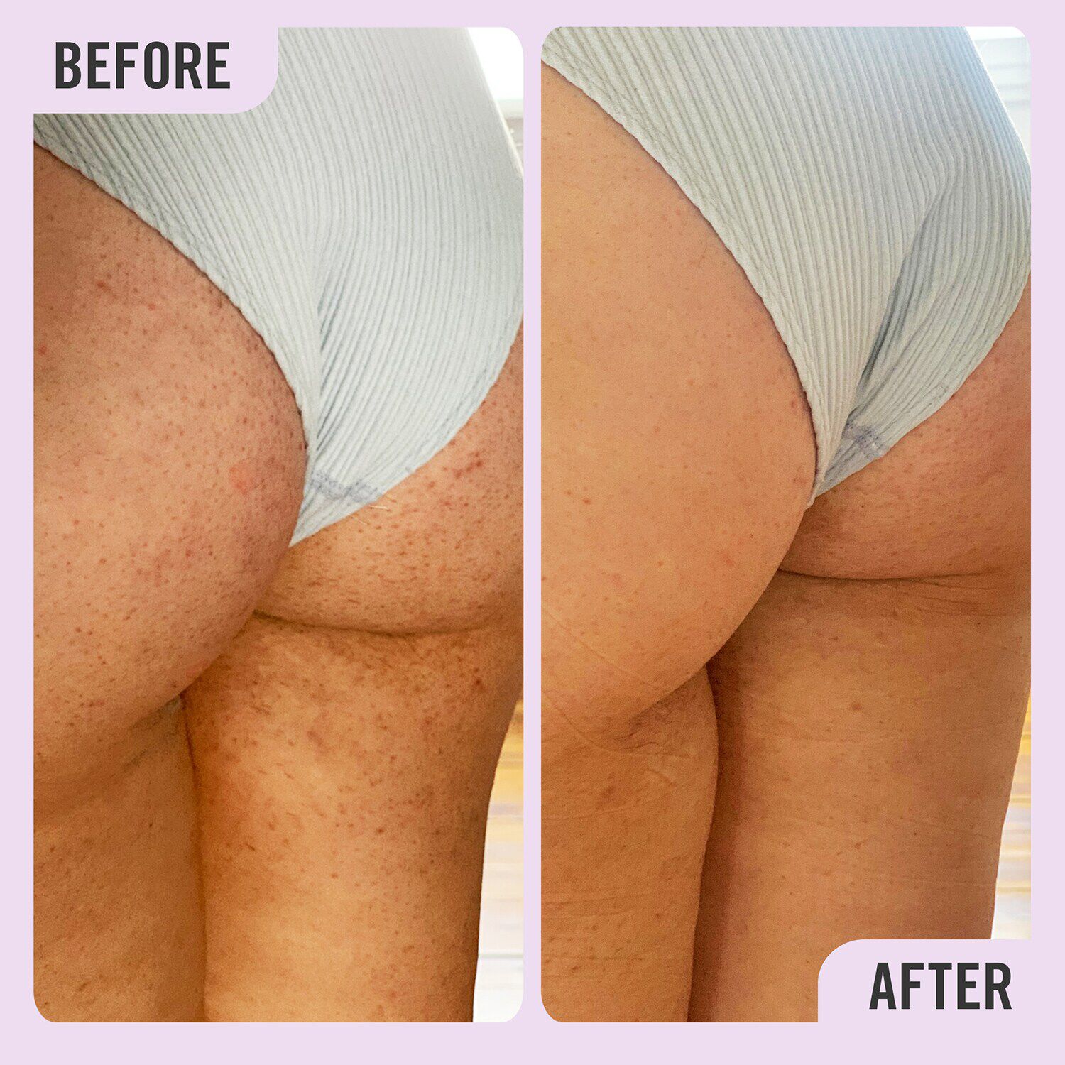 KP Bump Eraser Body Scrub with 10 AHA Vucut Peelingi FIRST AID BEAUTY SEPHORA